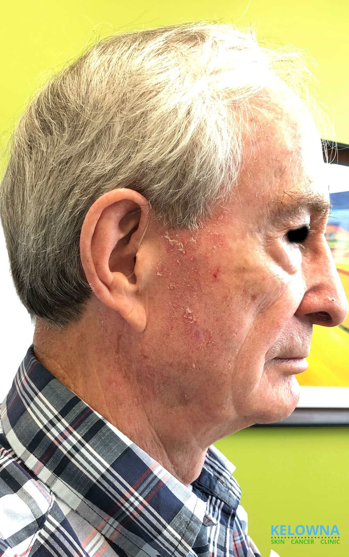 Image Gallery - Kelowna Skin Cancer Clinic