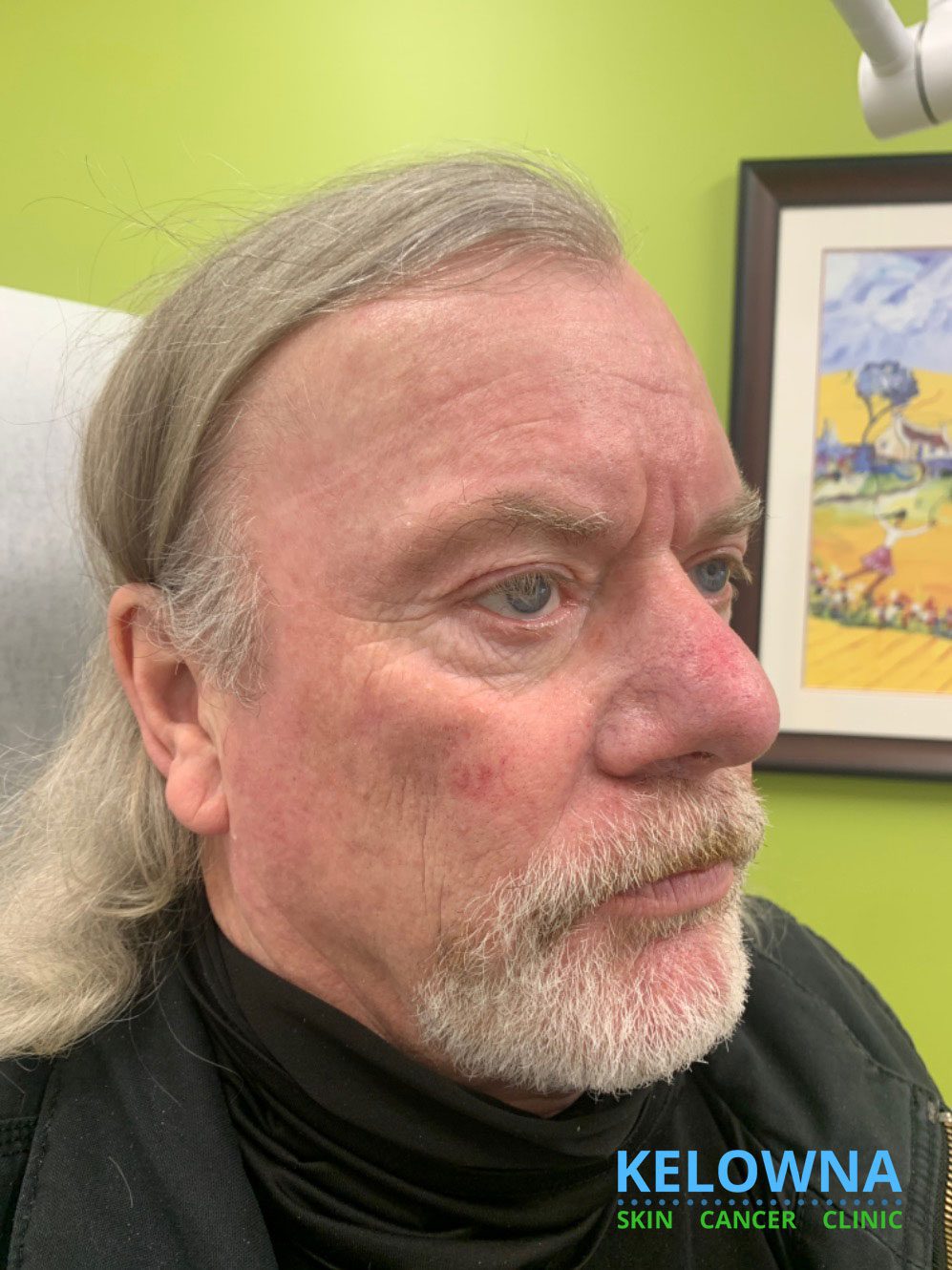 Image Gallery - Kelowna Skin Cancer Clinic